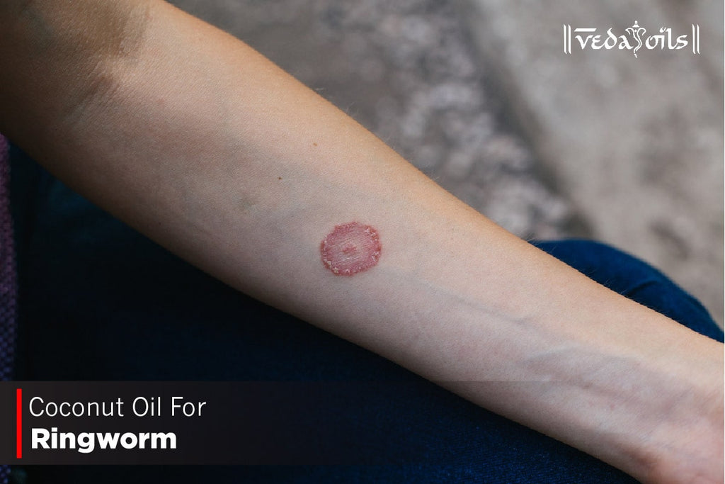 Coconut Oil For Ringworm - How To Use It? – VedaOils