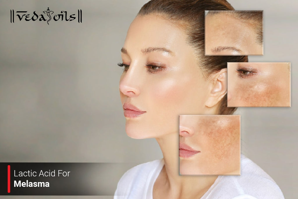 How Lactic Acid Helps Fade Melasma and Hyperpigmentation Naturally ...