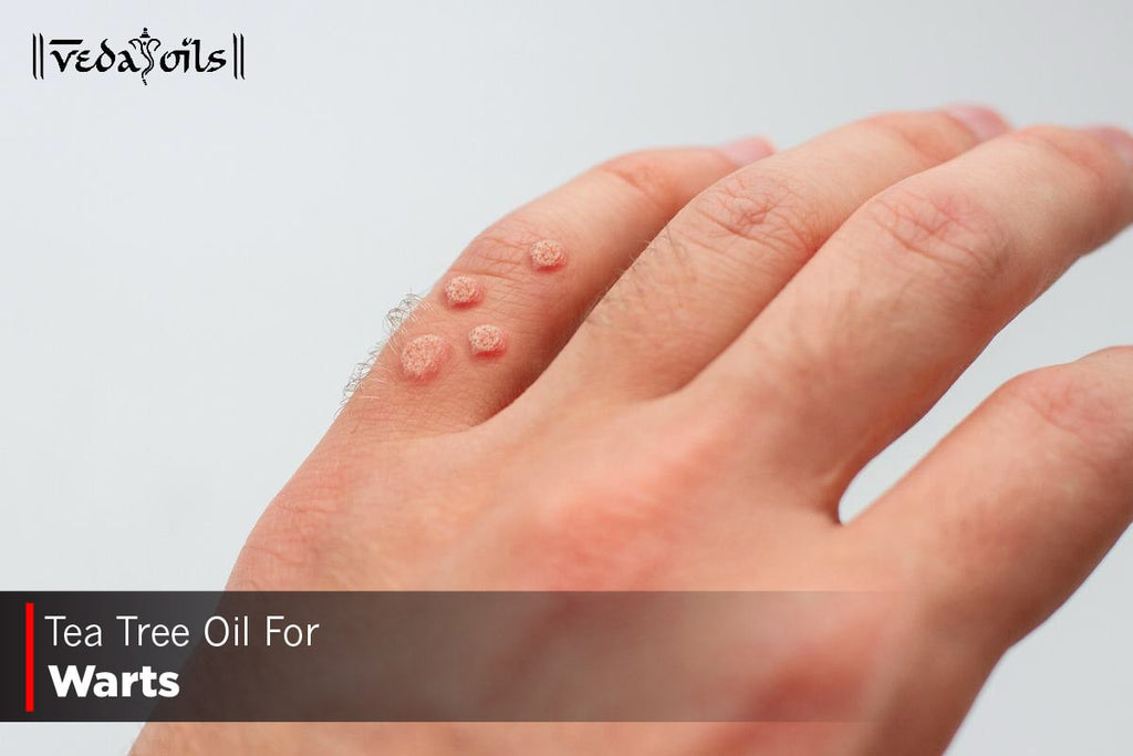 Tea Tree Oil For Warts - Benefits & Uses – VedaOils